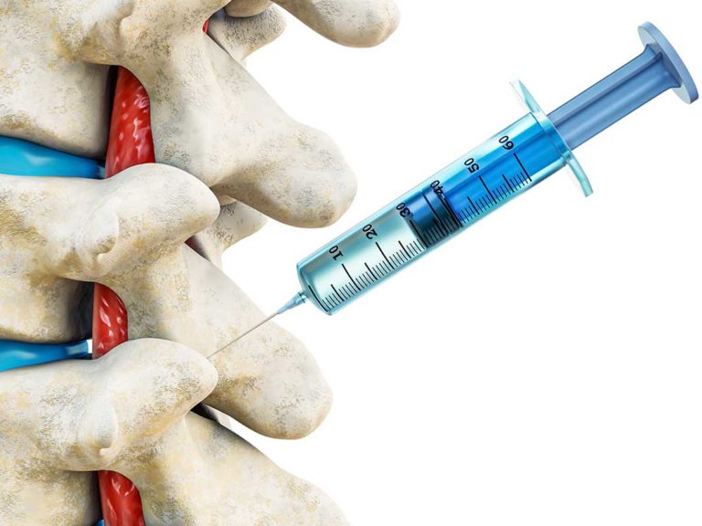 Facet Joint Injections – Janerich Pain Specialists